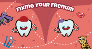 Frenulum In The Mouth - Possible Problems, Treatments, and Frenectomy